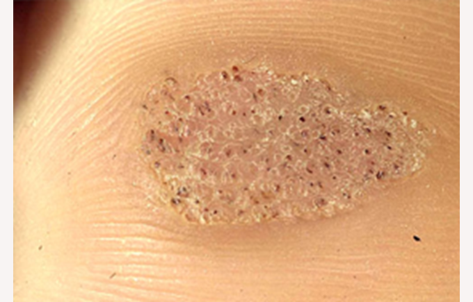 What to do if you child show signs of Verrucas/ Warts